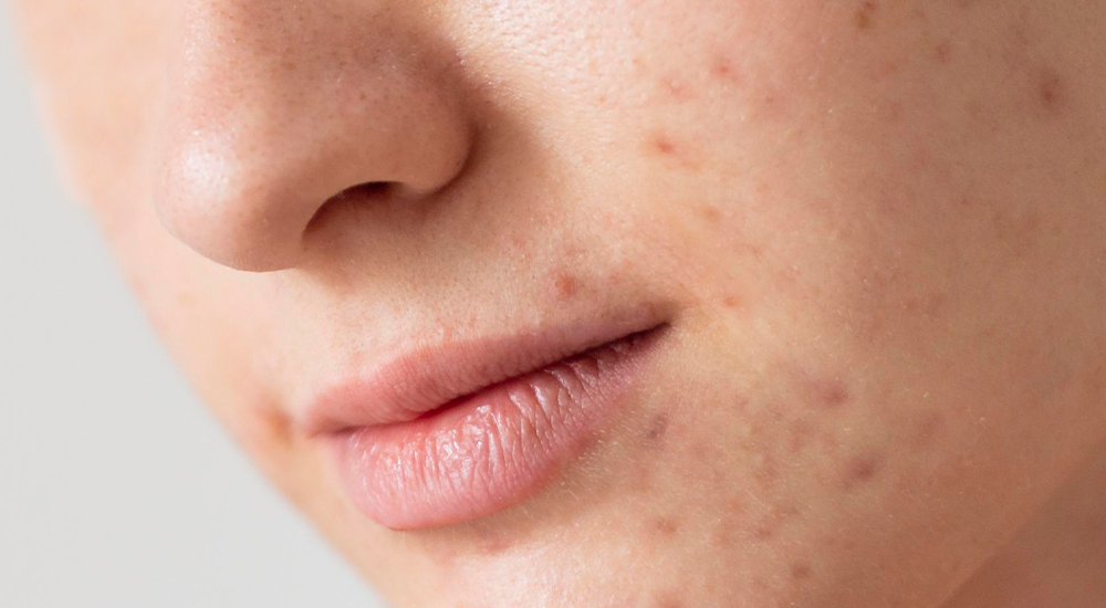 The best skincare routine for acne prone skin