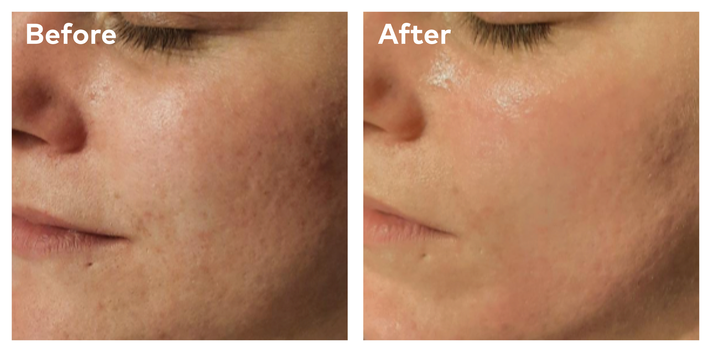 Hydrate & Glow with Hydradermabrasion