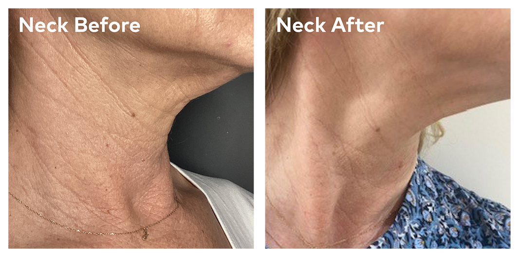 Profhilo Injectables Treatment NZ | Caci Clinics