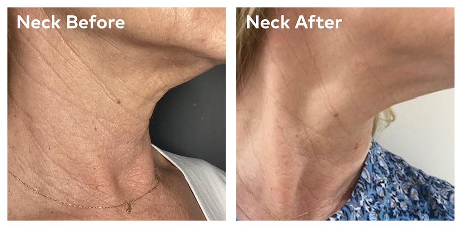 Profhilo Injectables Treatment NZ | Caci Clinics