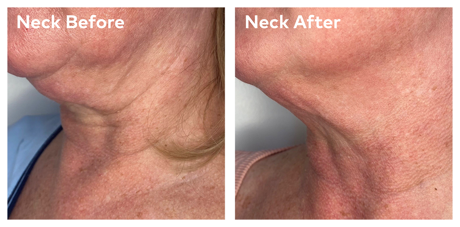 Profhilo Injectables Treatment NZ | Caci Clinics