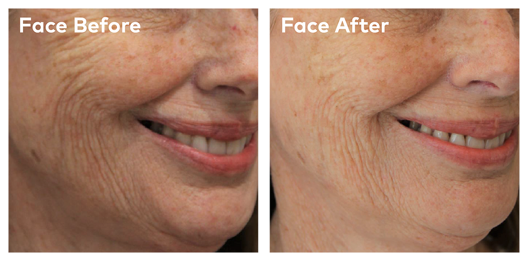 Profhilo Injectables Treatment NZ | Caci Clinics