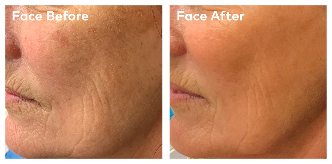 Profhilo Injectables Treatment NZ | Caci Clinics