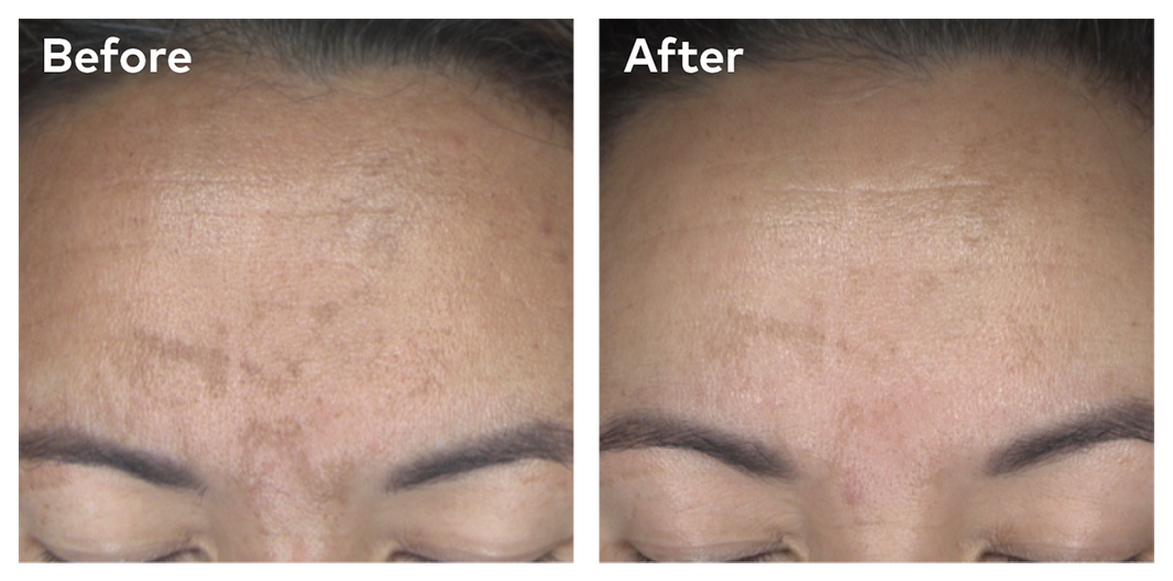 Melasma & Hormonal Pigmentation Treatments | Caci