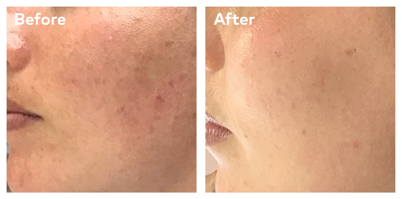 Melasma & Hormonal Pigmentation Treatments | Caci