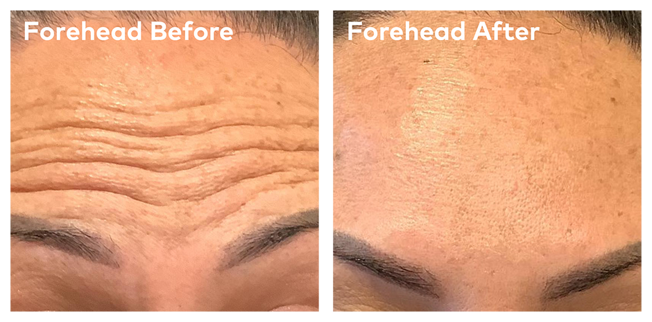 Anti Wrinkle Injections - Botox & Xeomin