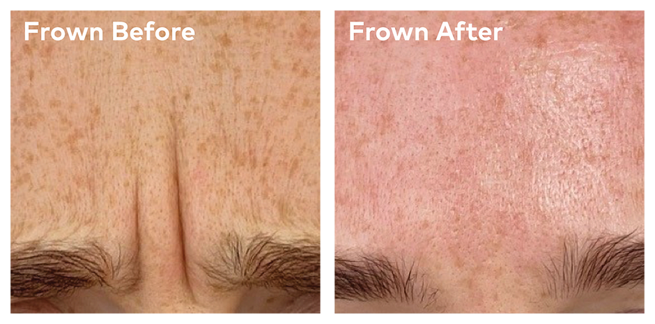 Anti Wrinkle Injections - Botox & Xeomin