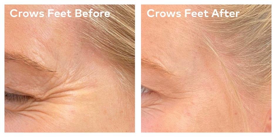Anti Wrinkle Injections - Botox & Xeomin