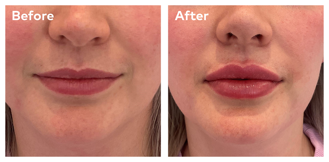 Lip Filler