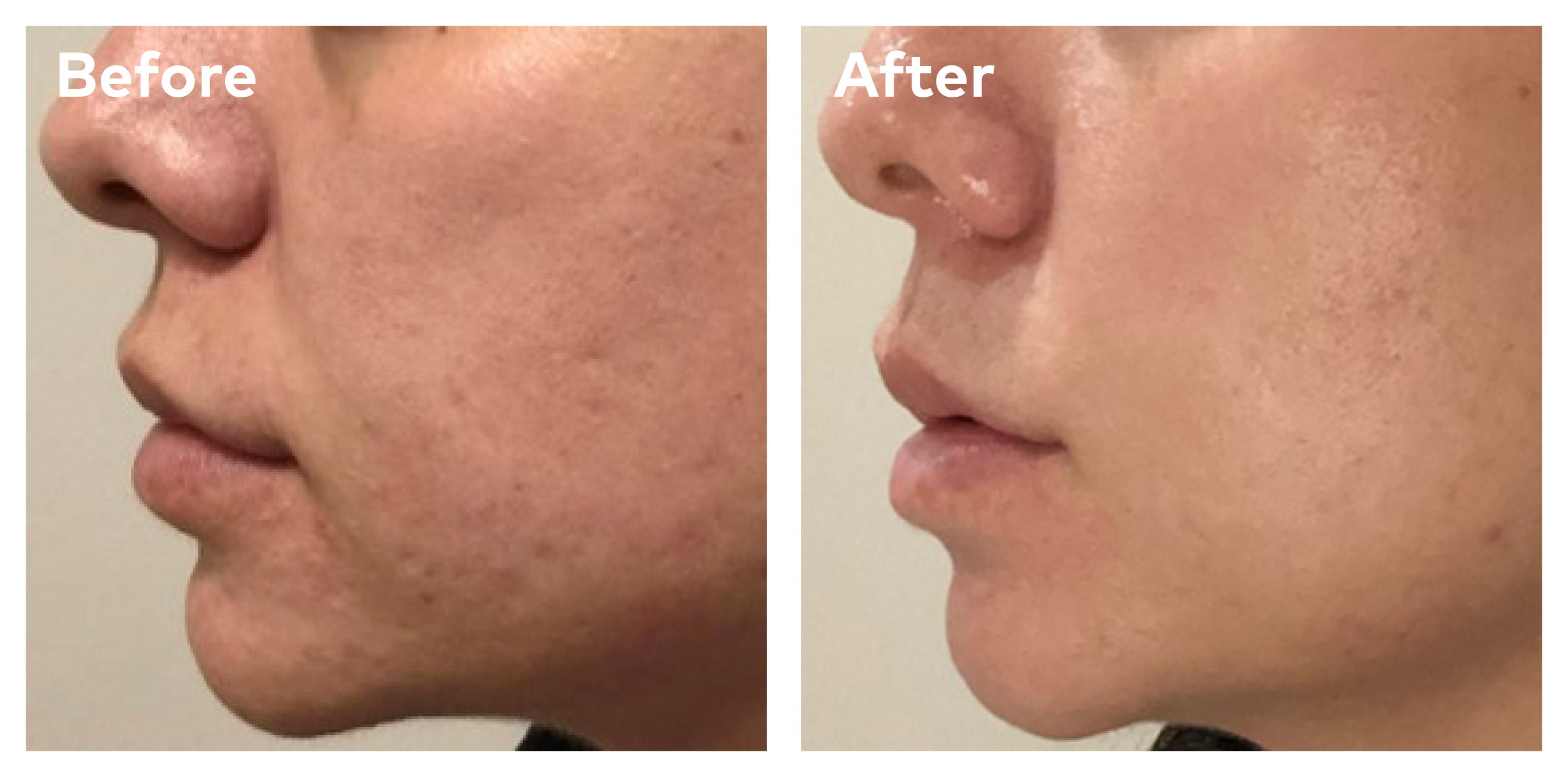 Microneedling Skin Treatment NZ | Boost Collagen & Smooth Skin | Caci ...