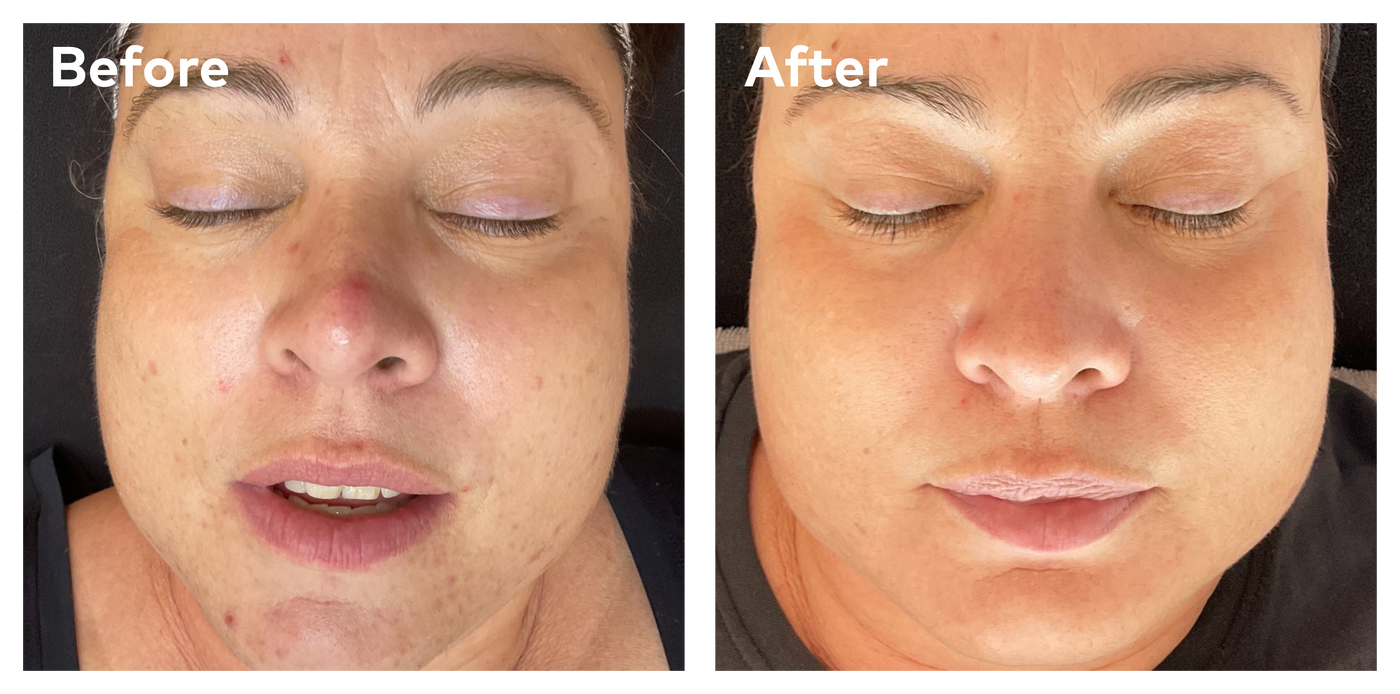 Caci Facial Laser