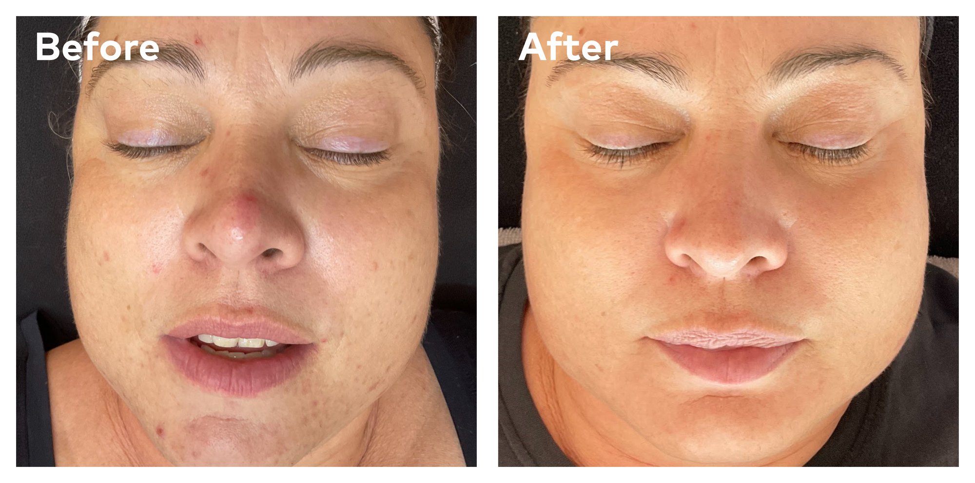 Caci Facial Laser