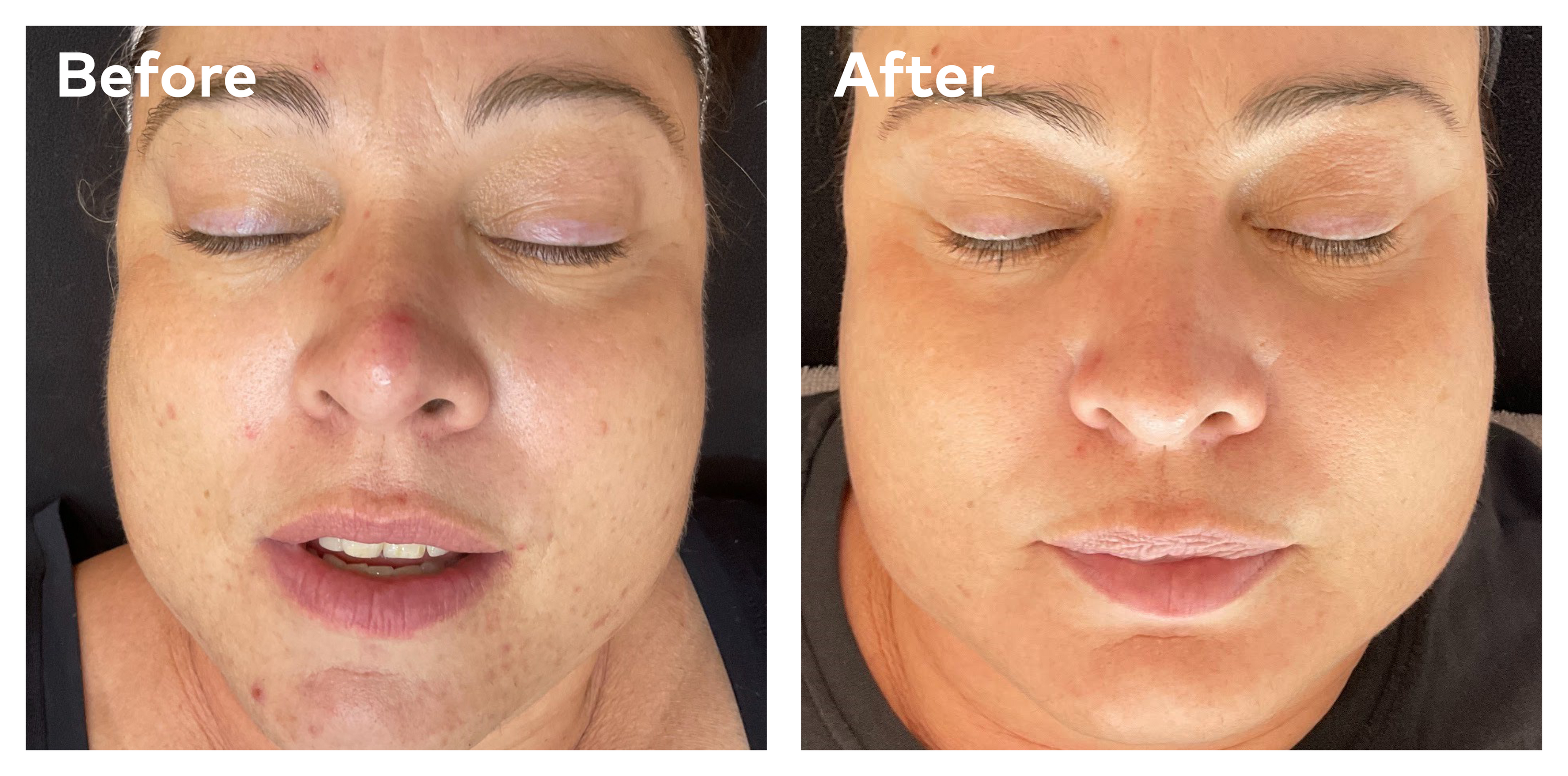 Caci Facial Laser