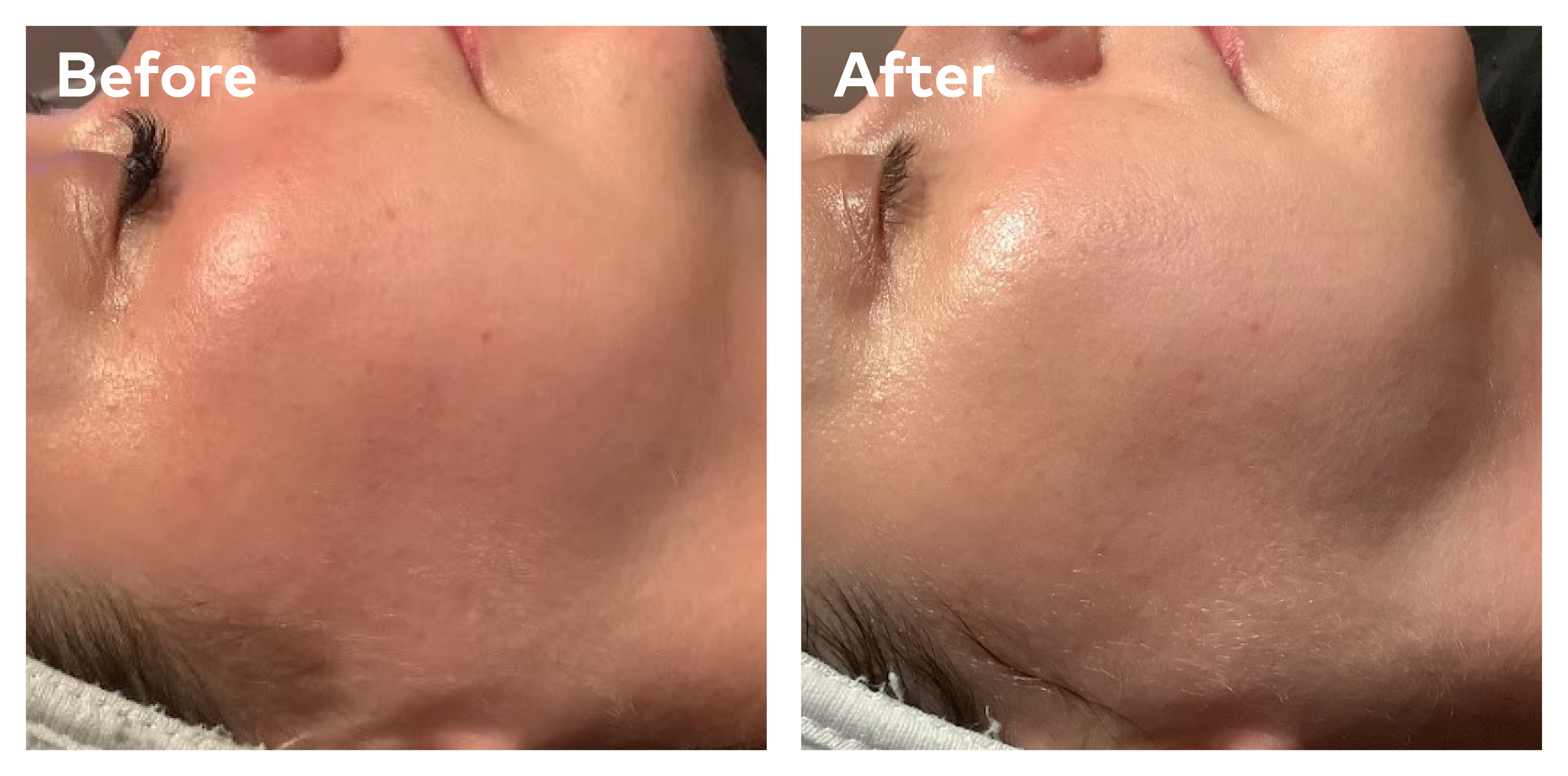 Caci Facial Laser