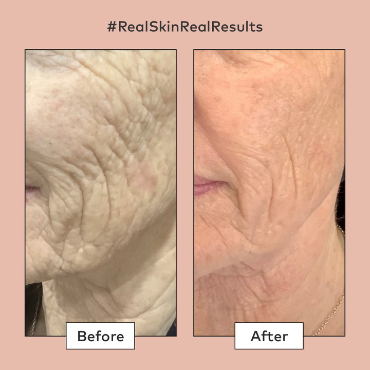 Fractional Co2 Laser