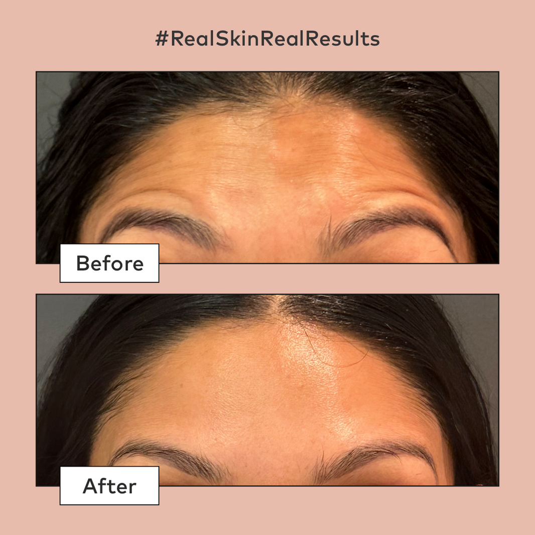 Anti Wrinkle Injections