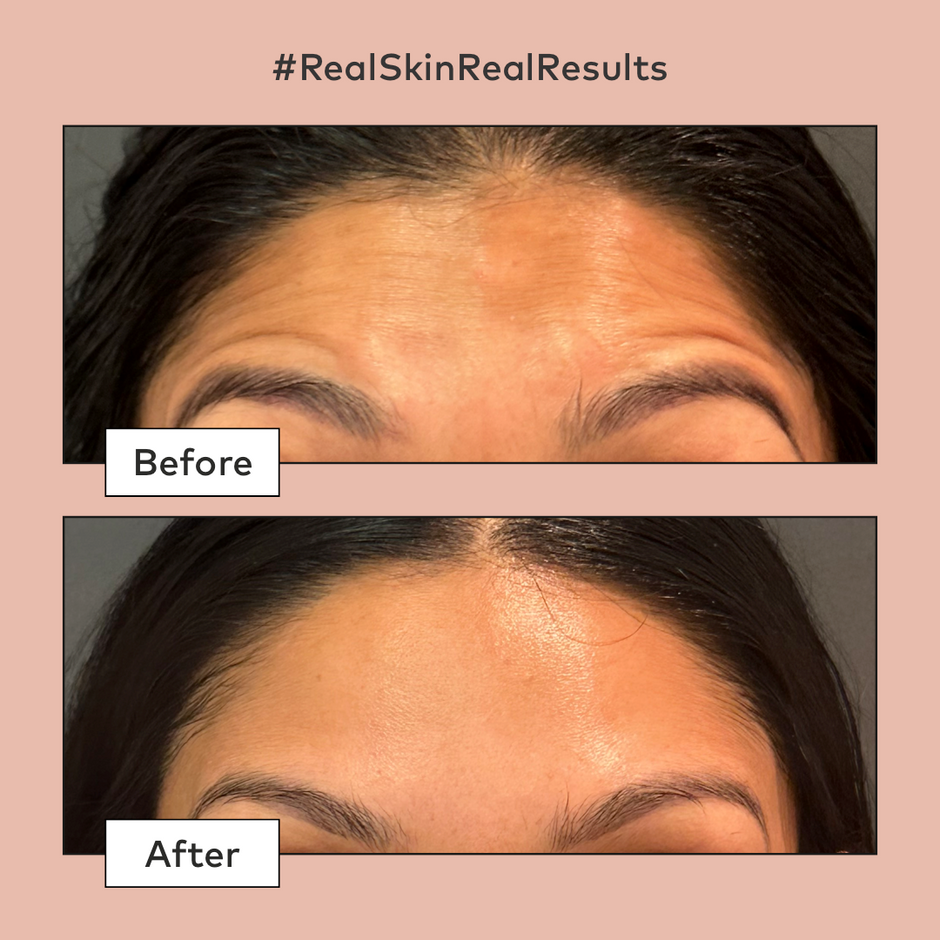 Anti Wrinkle Injections