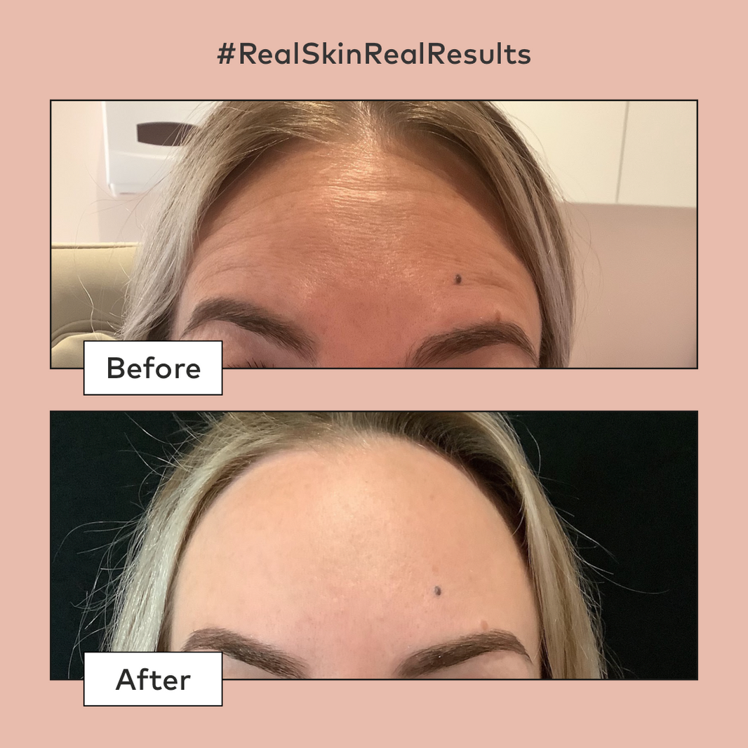 Anti Wrinkle Injections