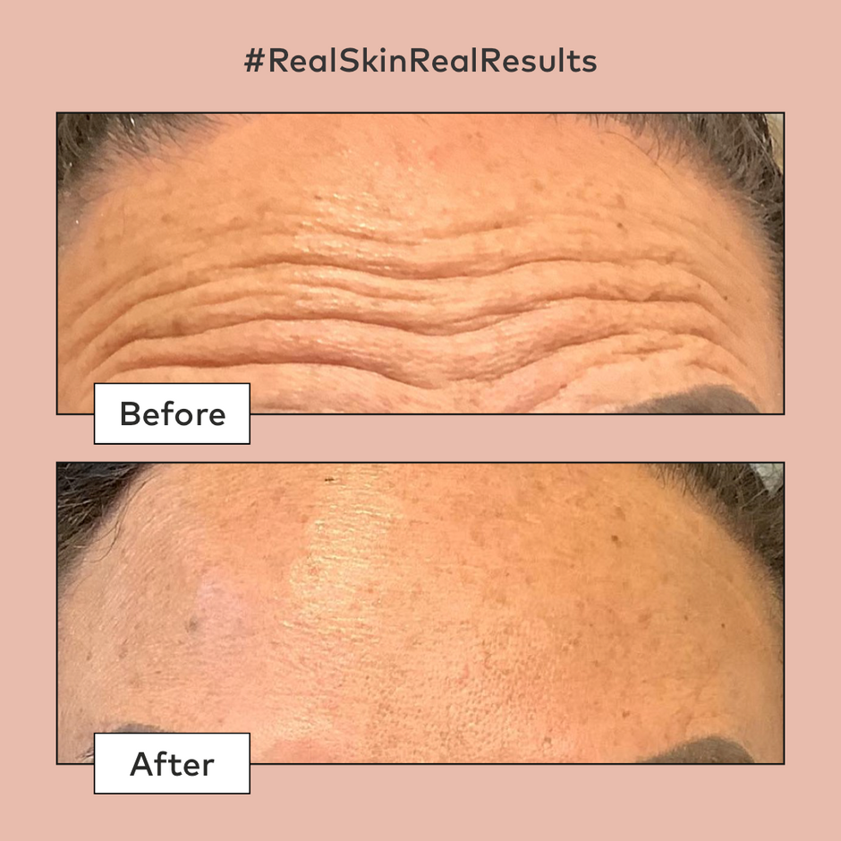 Anti Wrinkle Injections